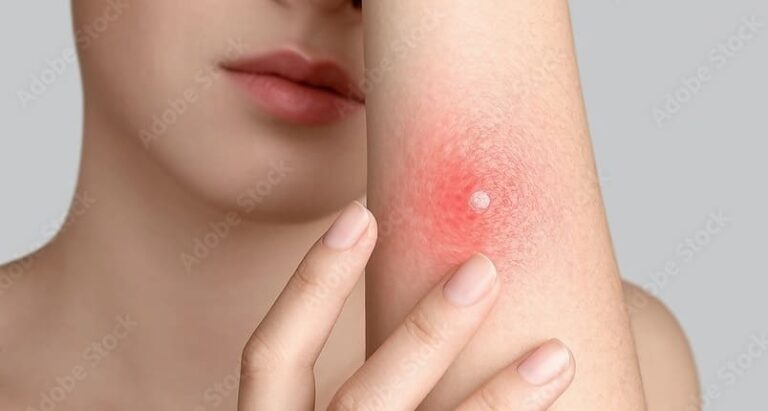 Boils: Causes, Symptoms, Treatment, Home Remedies & Prevention