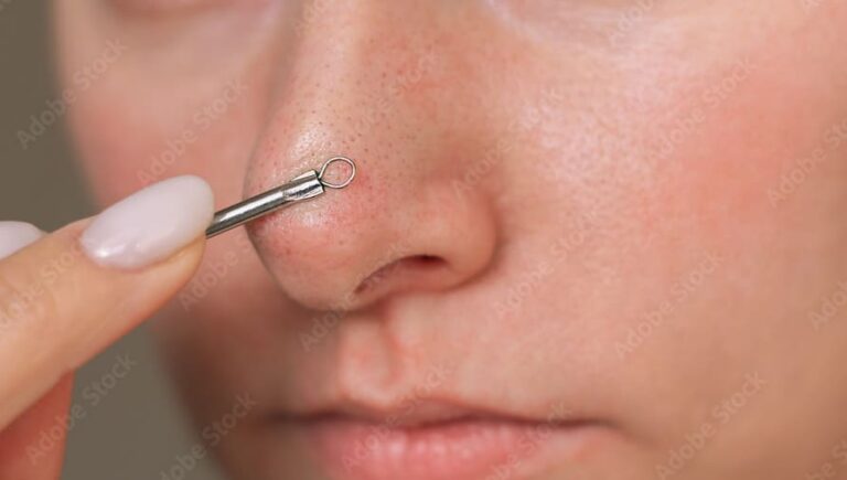 Deep Blackheads: Causes, Treatments, Home Remedies & Prevention