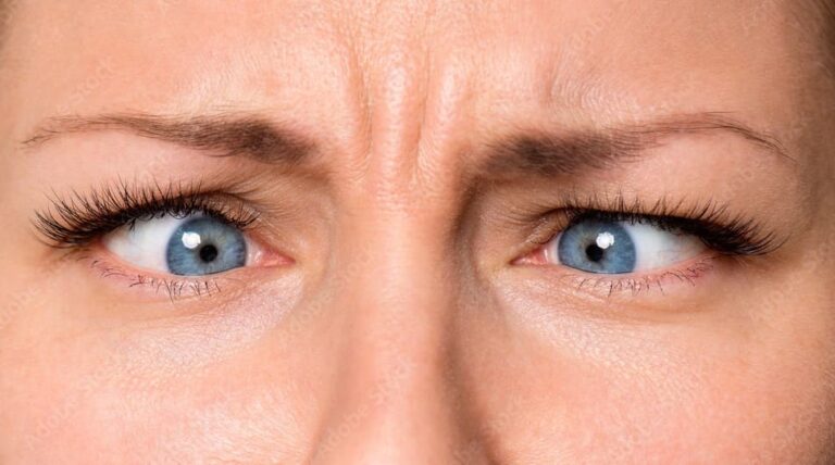 Squint Eyes: Causes, Symptoms, Treatment, Exercises & Prevention