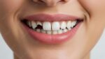 Chipped Tooth: Causes, Treatments, Complications & Prevention