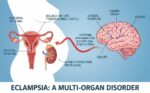 Eclampsia: Types, Causes, Symptoms, Risks, Treatment & Diagnosis