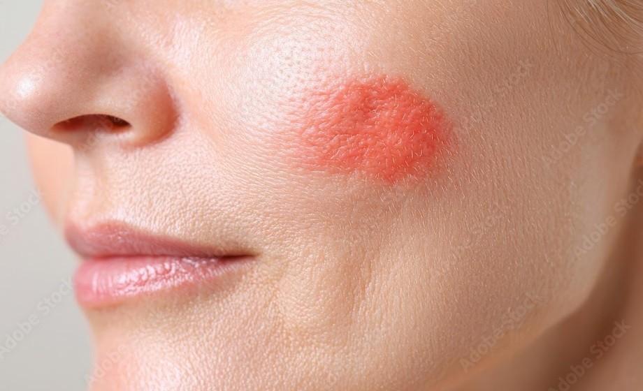 What Patchy Skin Color Indicates About Circulation Problems