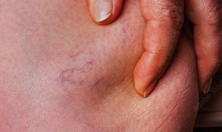 Spider Angioma: Causes, Symptoms, Treatment & Prevention