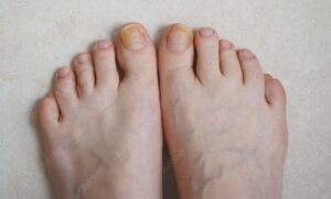 warning signs in your toenails Archives - Myhealthopedia
