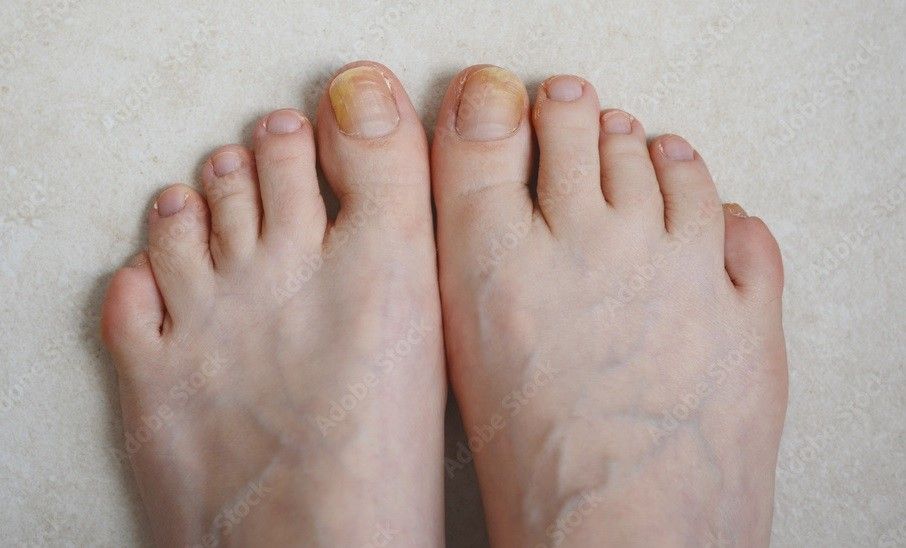 toenail changes Archives - Myhealthopedia